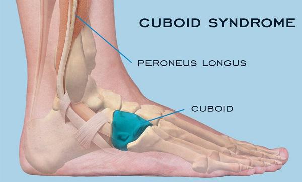 Cuboid Syndrome Next Step Foot Ankle Clinic