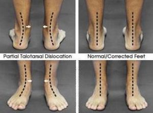 HyProCure | Next Step Foot & Ankle Clinic