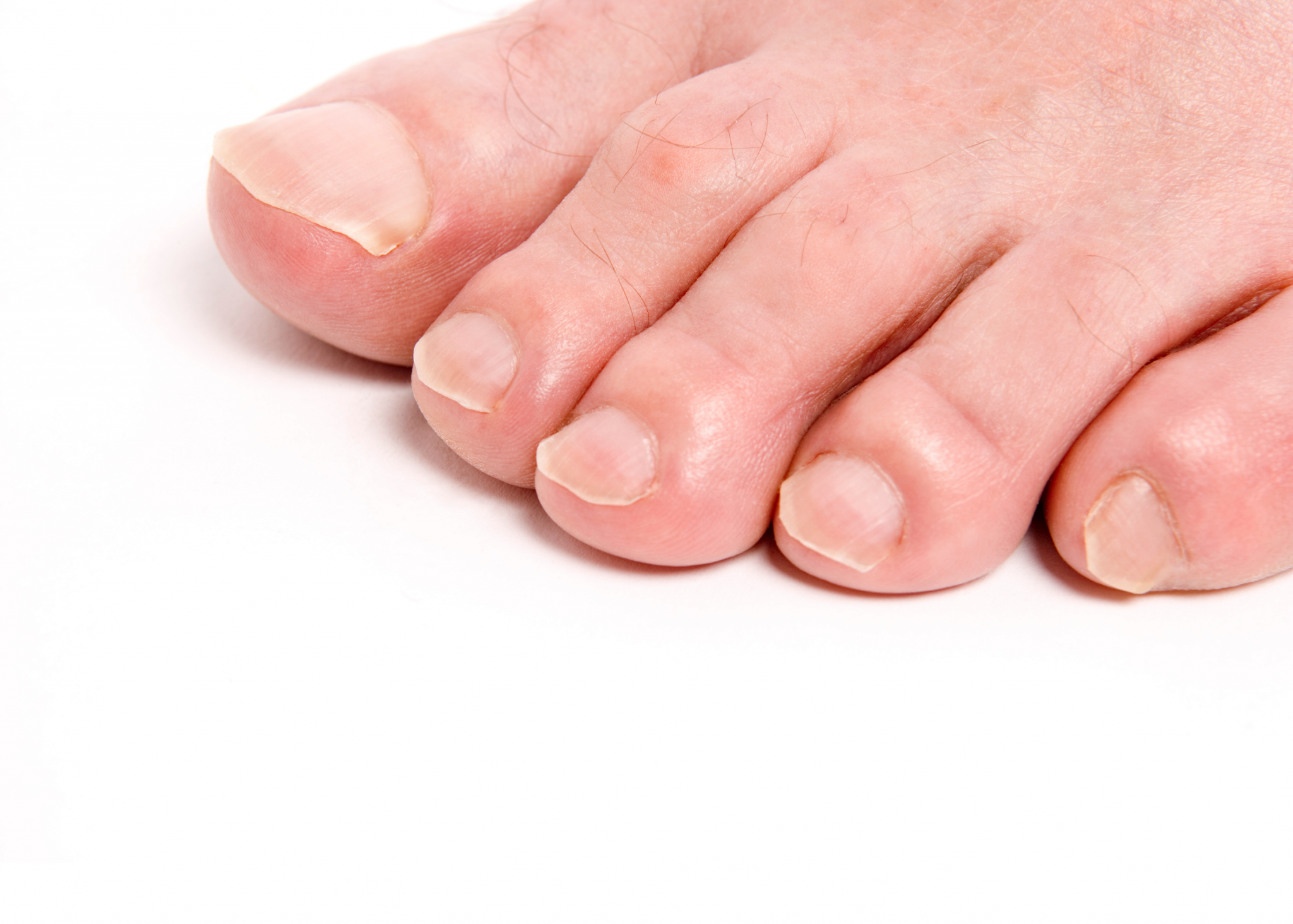 5 Things to Know About Hammertoes | Next Step Foot & Ankle Clinic