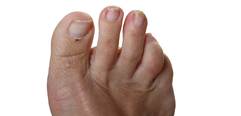 Claw Toe: Curled Under Digits | Next Step Foot & Ankle Clinic