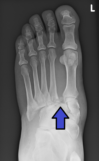 What is a Lisfranc Injury? | Next Step Foot & Ankle Clinic
